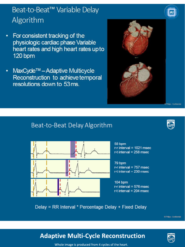 Beat-to-Beat™ Variable Delay Algorithm_AI_ | PDF