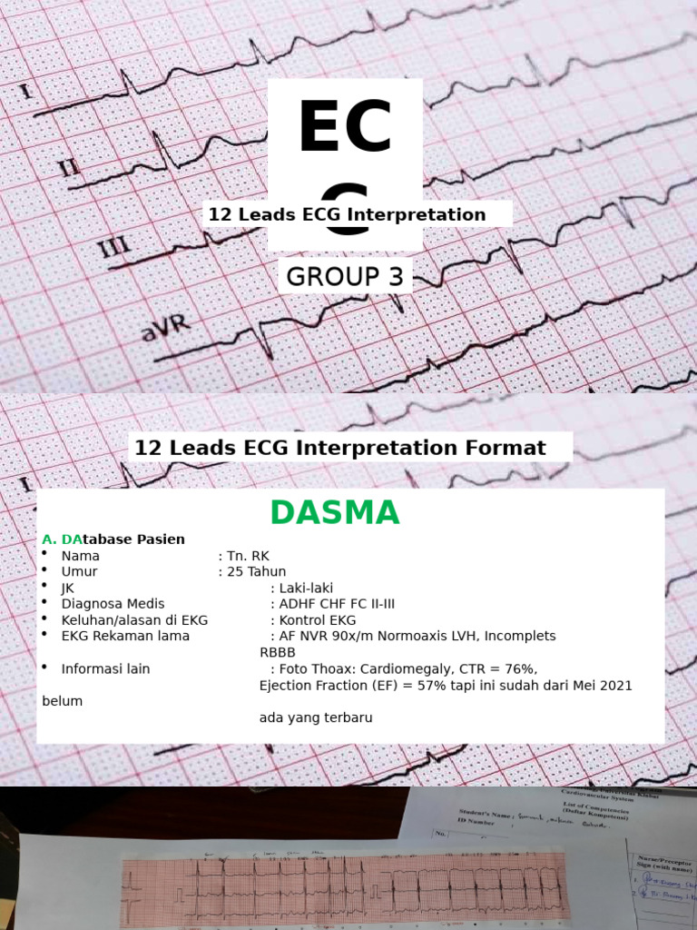 Interpretasi EKG 12 Lead untuk AF dan LVH | PDF