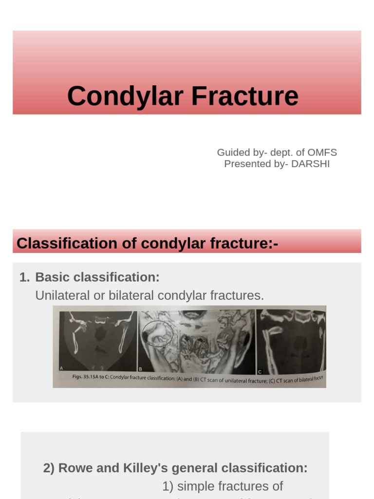 Condylar Fracture | PDF | Skeletal System | Musculoskeletal System
