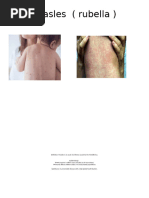 Measles Lecture Presentation | PDF