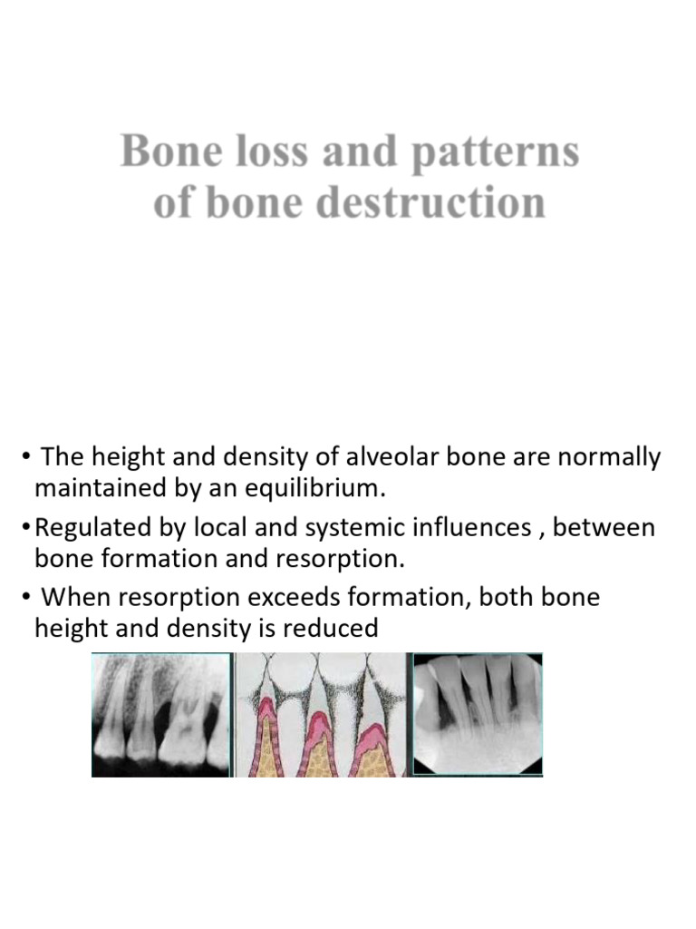 17 - Bone Loss and Patterns of Bone Destruction | PDF | Periodontology ...