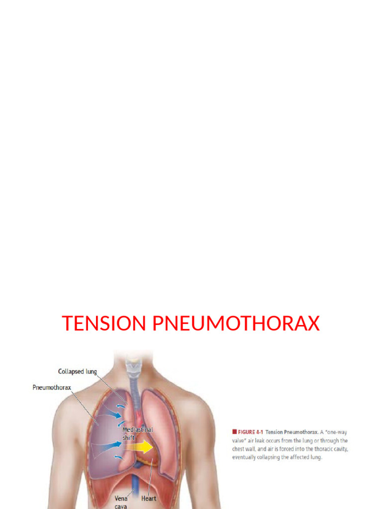 Tens Pneumothorax | PDF