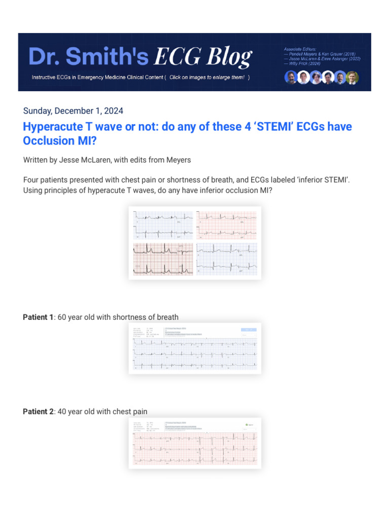 Analyzing Hyperacute T Waves in STEMI | PDF | Electrocardiography ...