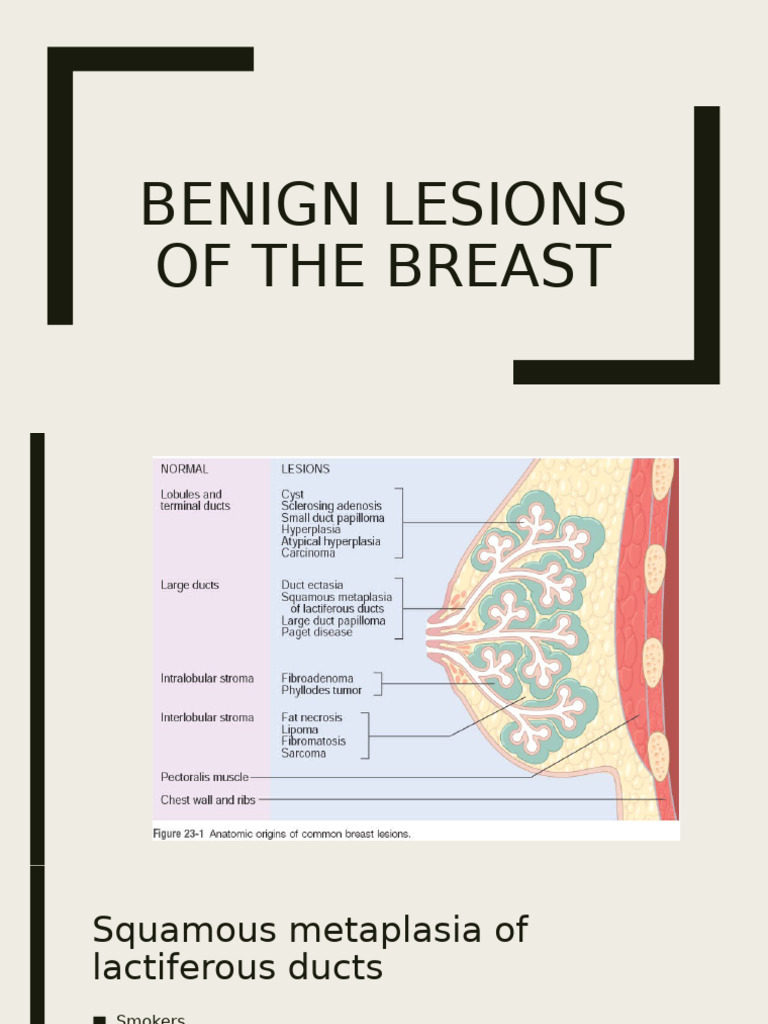 Benign Conditions of The Breast | PDF | Epithelium | Carcinoma