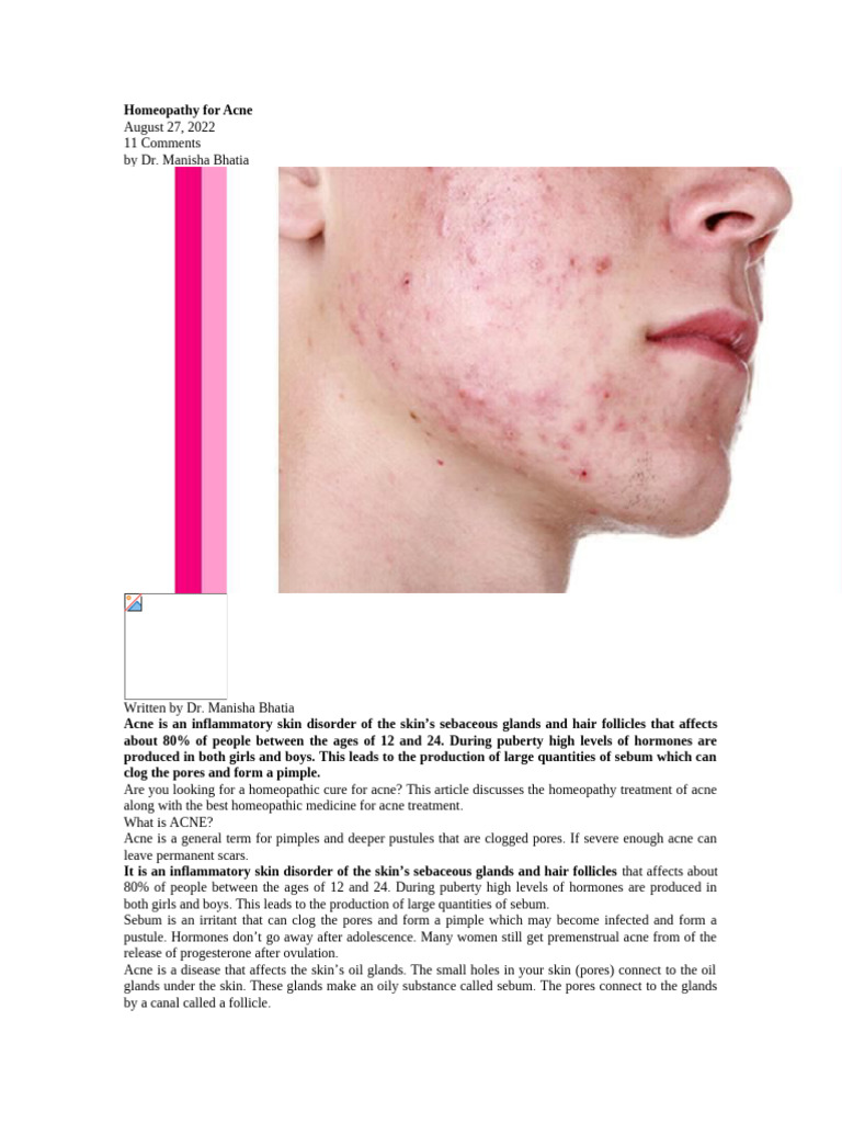 Acne | PDF | Skin | Dermatology