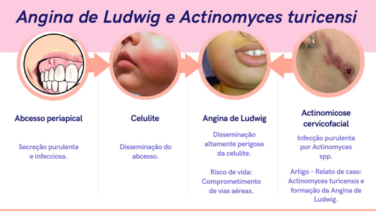 Angina de Ludwig e Actinomyces turicensi | PDF