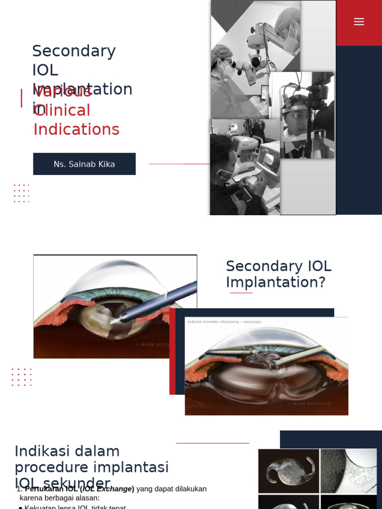Indikasi dan Teknik Implantasi IOL Sekunder | PDF