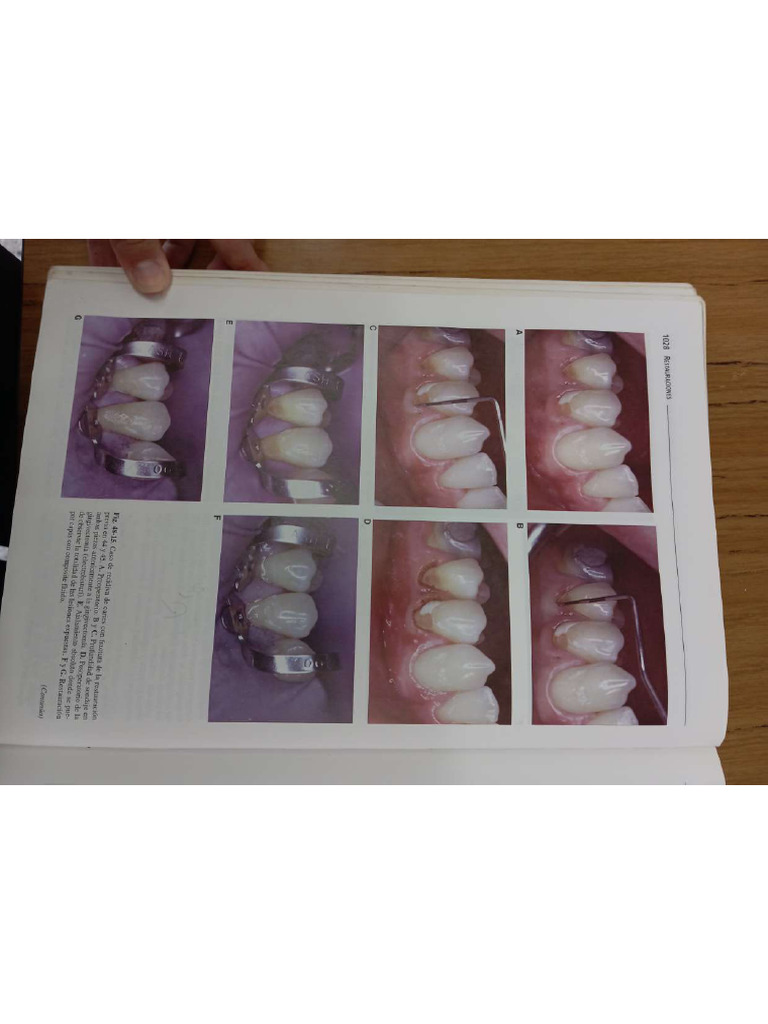 Restauraciones Clase V | PDF