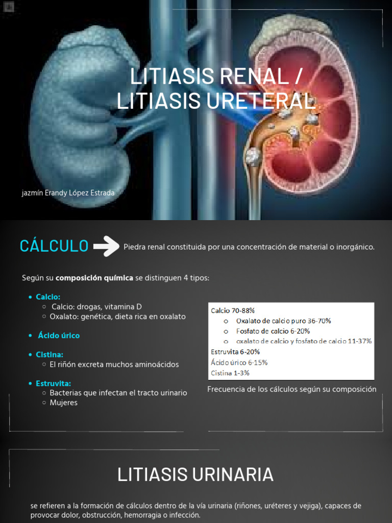 Tratamiento de Litiasis Urinaria | PDF | Enfermedades y trastornos ...