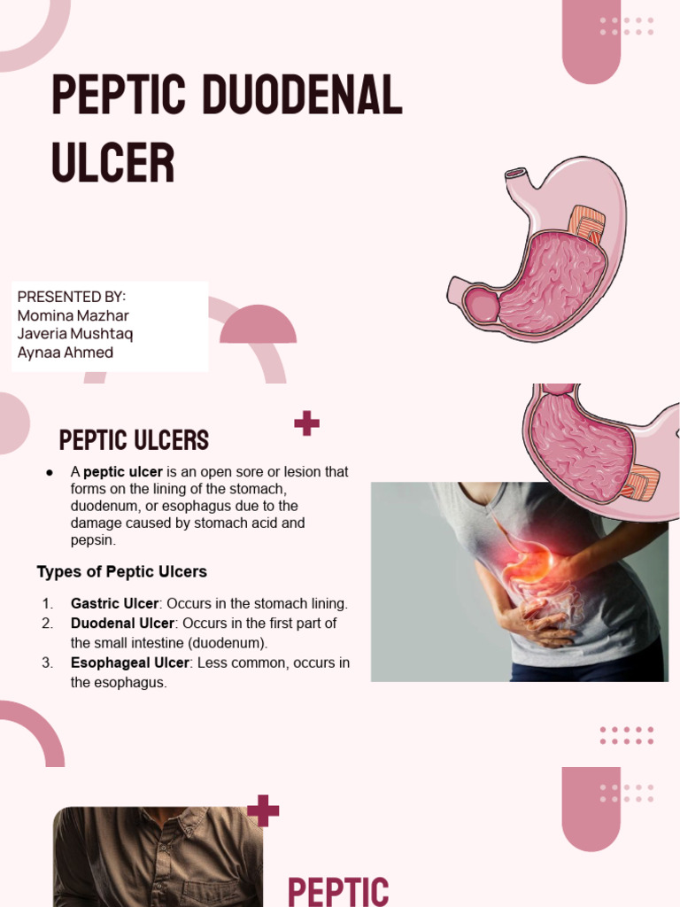 Stomach Ulcer by Slidesgo-2 | PDF | Causes Of Death | Digestive Diseases