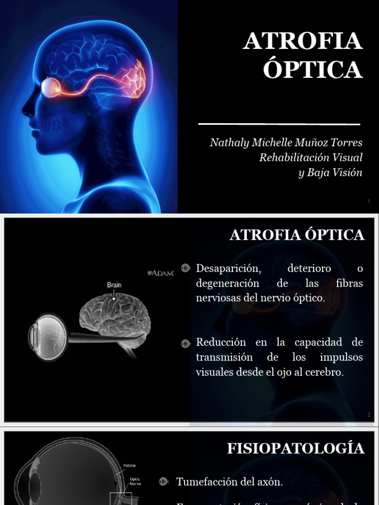 Atrofia Óptica | PDF | Percepción visual | Isquemia