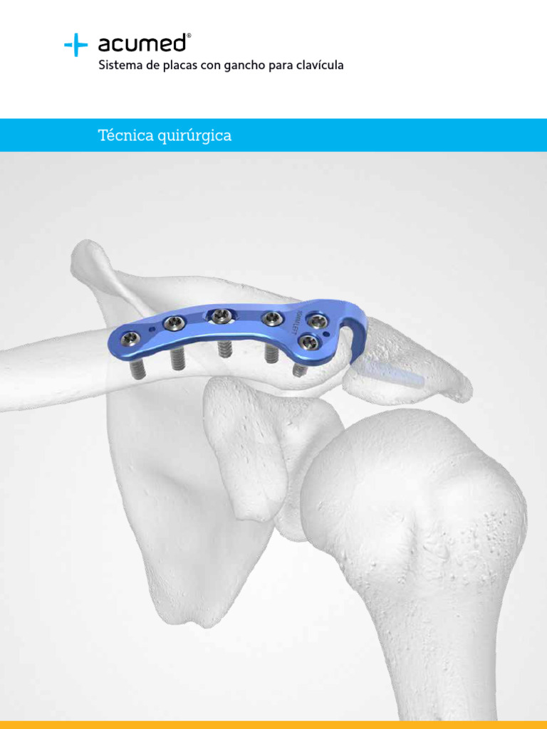 Acumed Surgical Technique ES Clavicle Hook Plating System ESSHD10 10 A ...