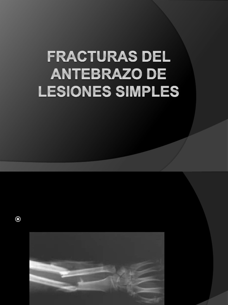 Fracturas Del Antebrazo De Lesiones Simples Pdf Codo Sistema