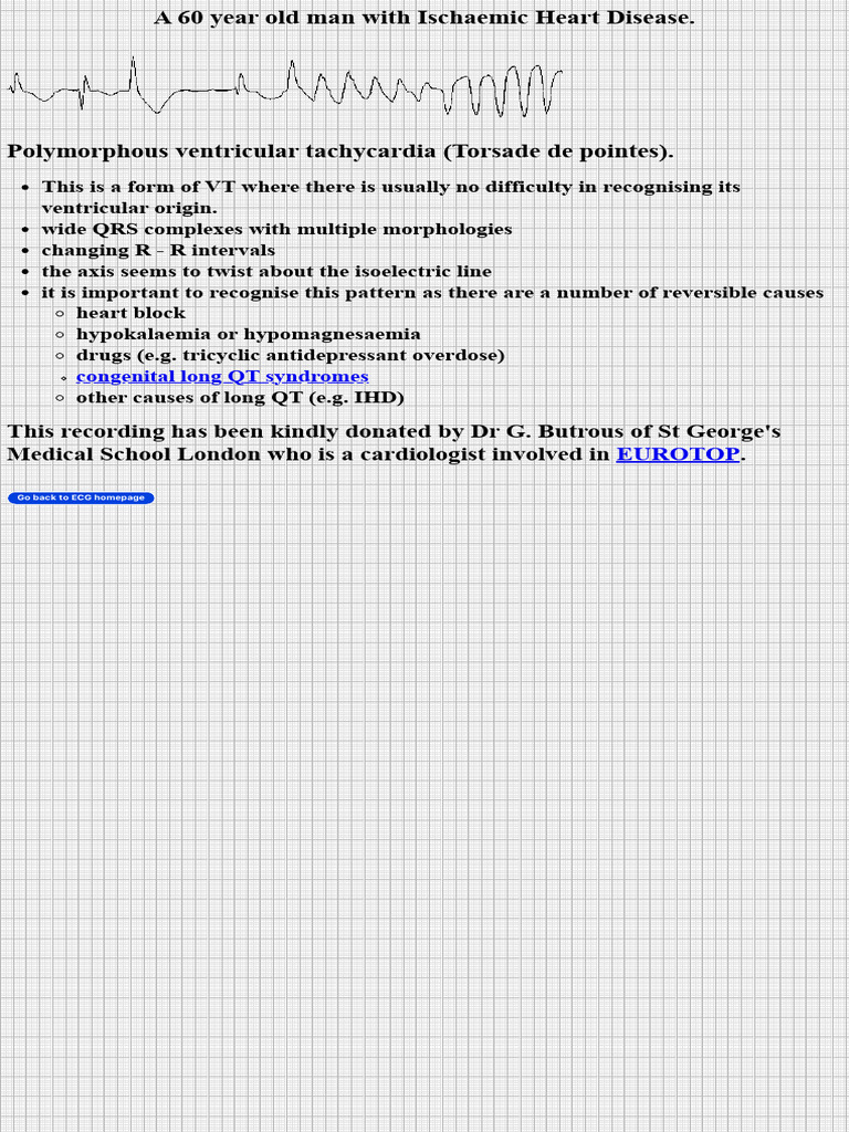 Torsade de Pointes VT | PDF Torsade de Pointes VT | PDF