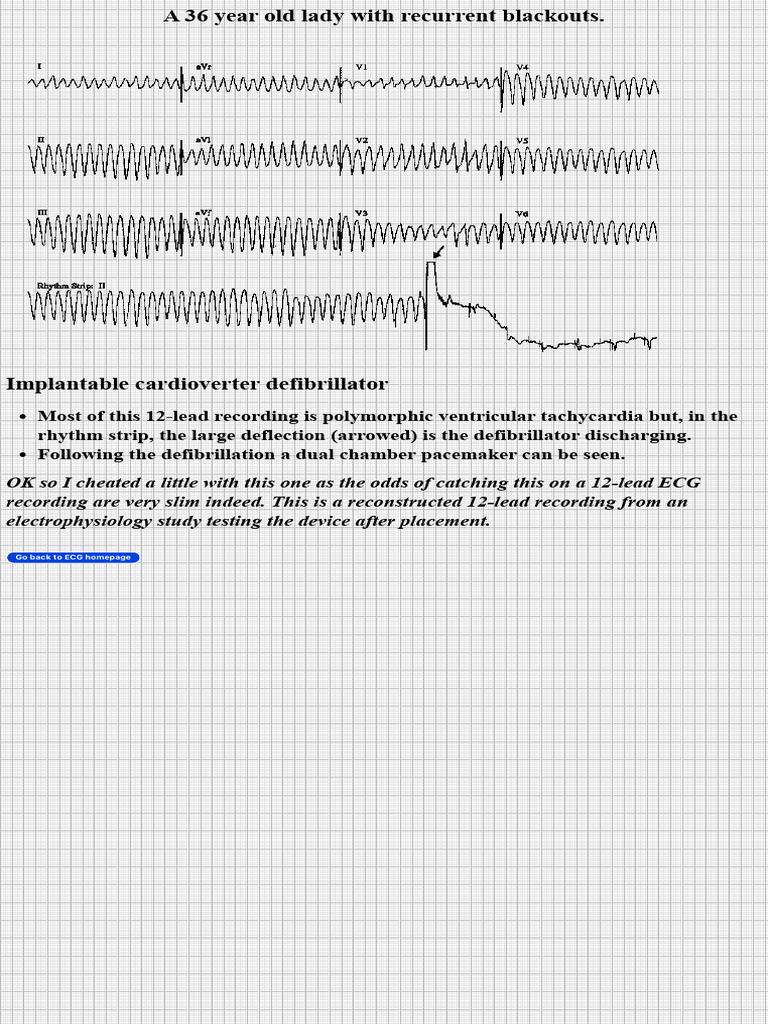 Implantable Cardioverter Defibrillator | PDF
