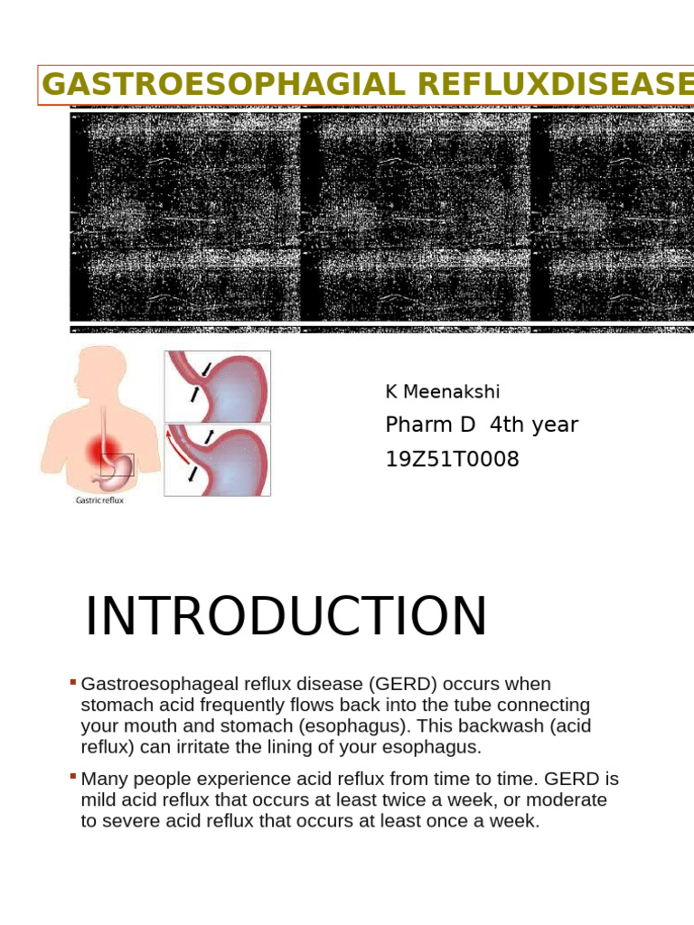 19Z51T0008 Gerd 4 | PDF | Gastroesophageal Reflux Disease | Esophagus