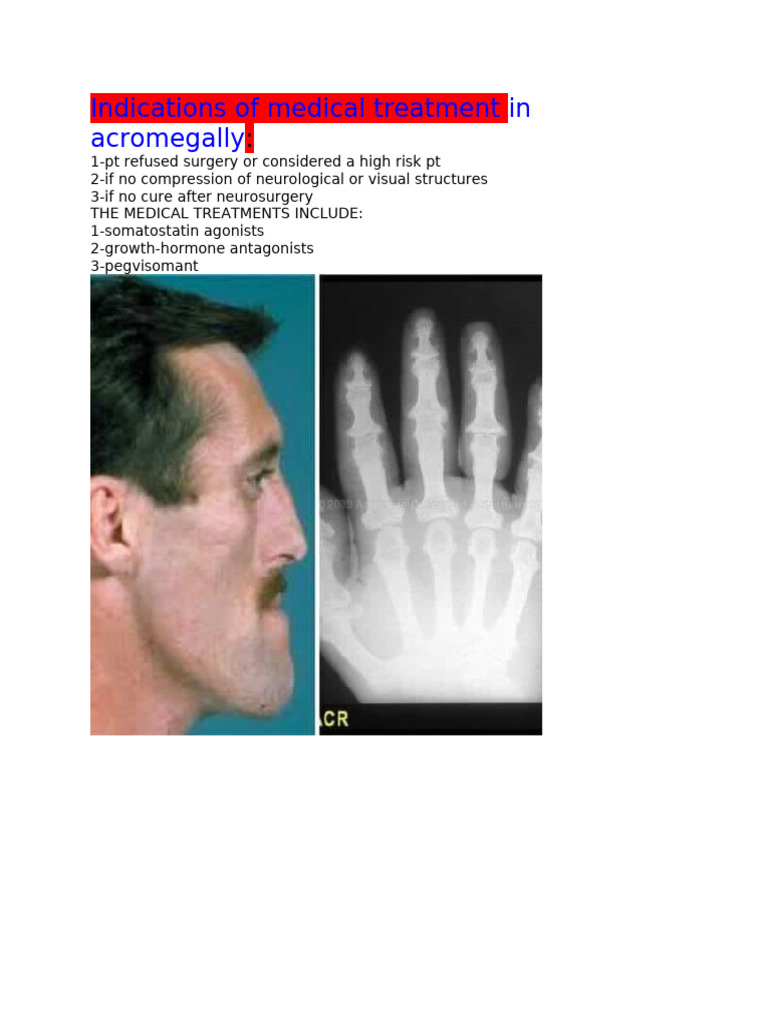 Indications of Medical Treatment in Acromegally | PDF