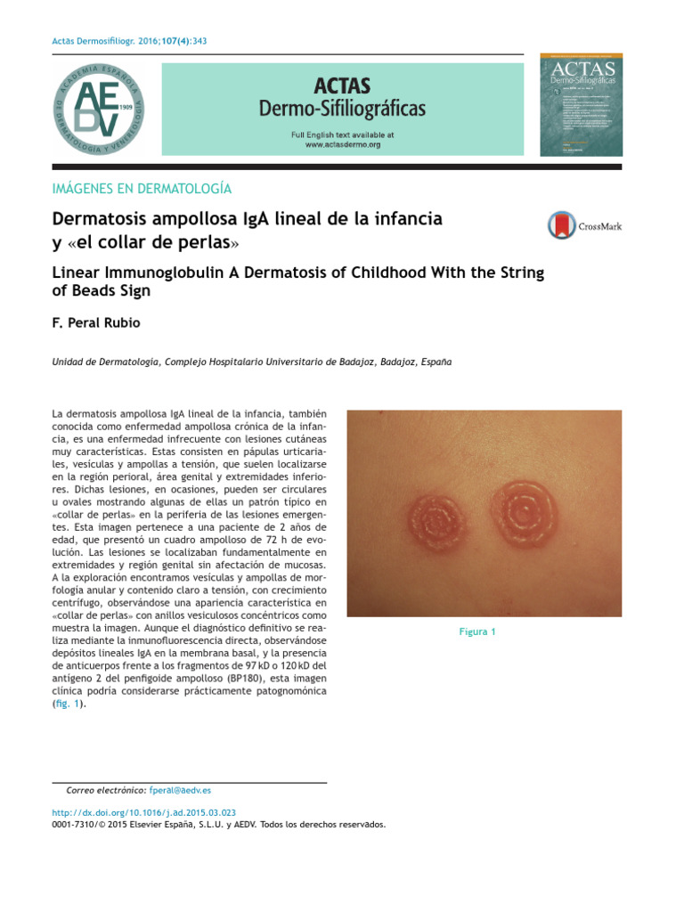 Dermatosis Ampollosa IgA Lineal de La Infancia | PDF