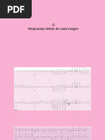 Tipos de Ritmos Cardíacos y Bloqueos AV | PDF