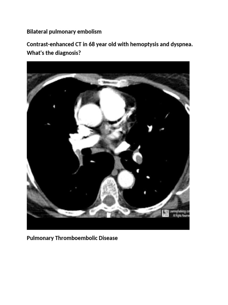 Bilateral Pulmonary Embolism CT Findings | PDF | Embolism | Lung
