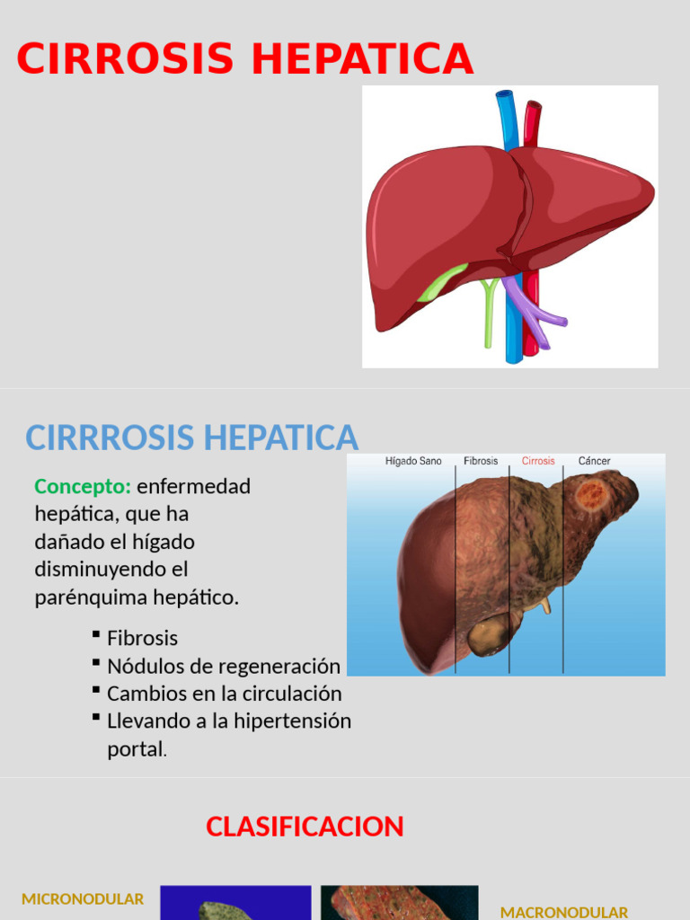 Cirrosis Hepatica | PDF | Cirrosis | Causas de la muerte