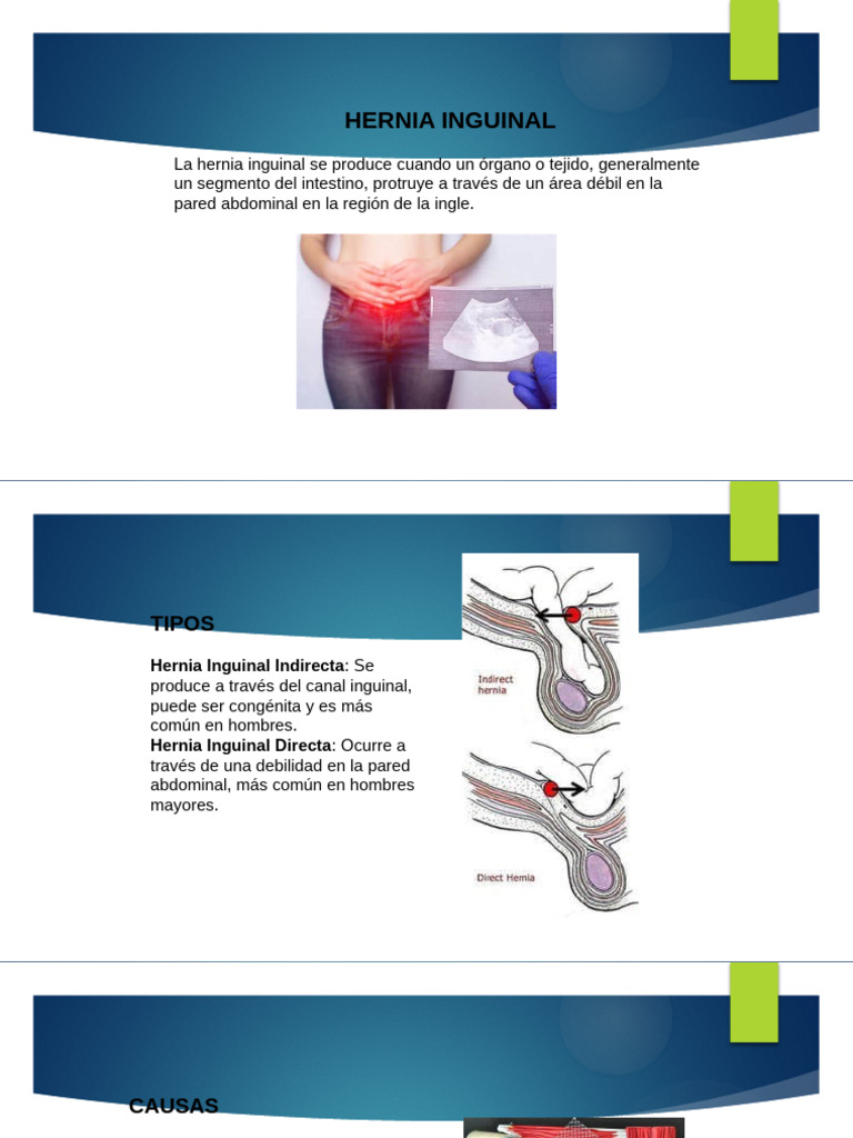 Hernia Inguinal | PDF | Medicina CLINICA | Medicina