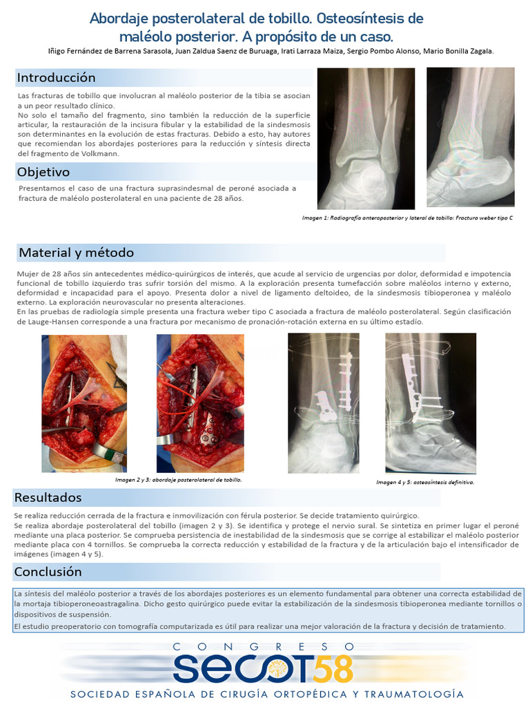 Osteosíntesis de Maléolo Posterior | PDF | Tobillo | Enfermedades y ...