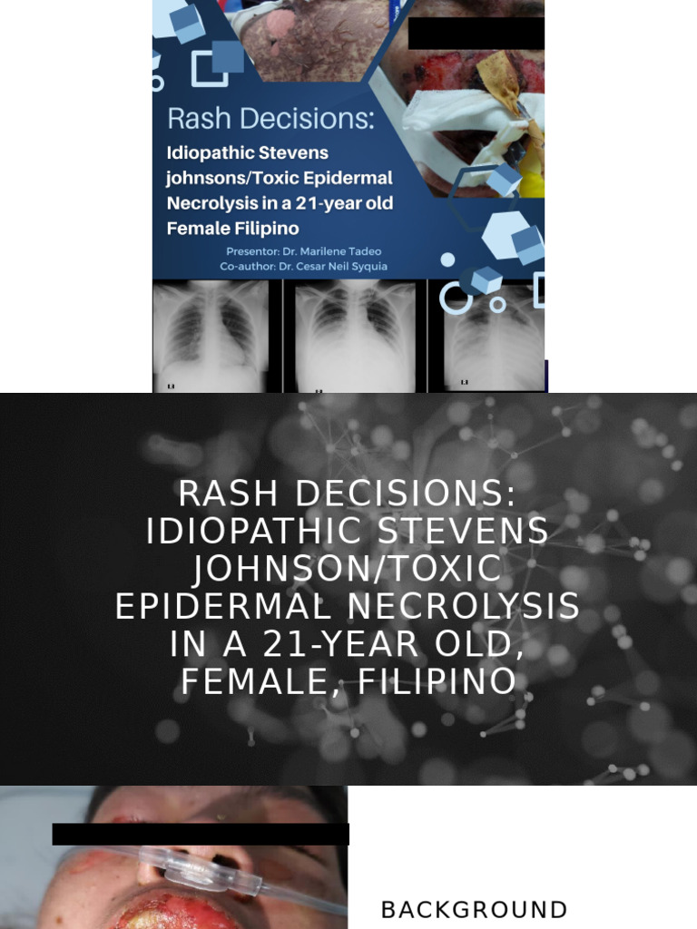 Rash Decisions Idiopathic Stevens Johnson Toxic Epidermal Necrolysis in ...
