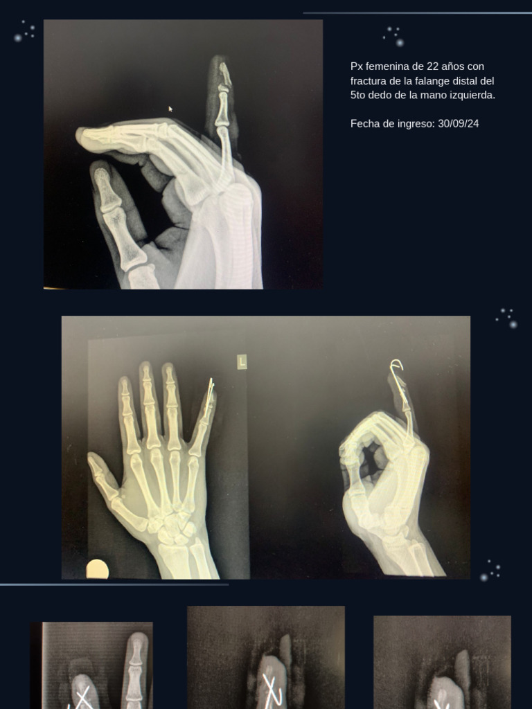 Fractura falange distal | PDF