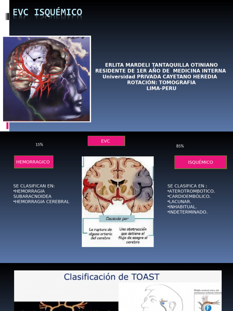 Evc Isquemico | PDF | Carrera | Sistema nervioso