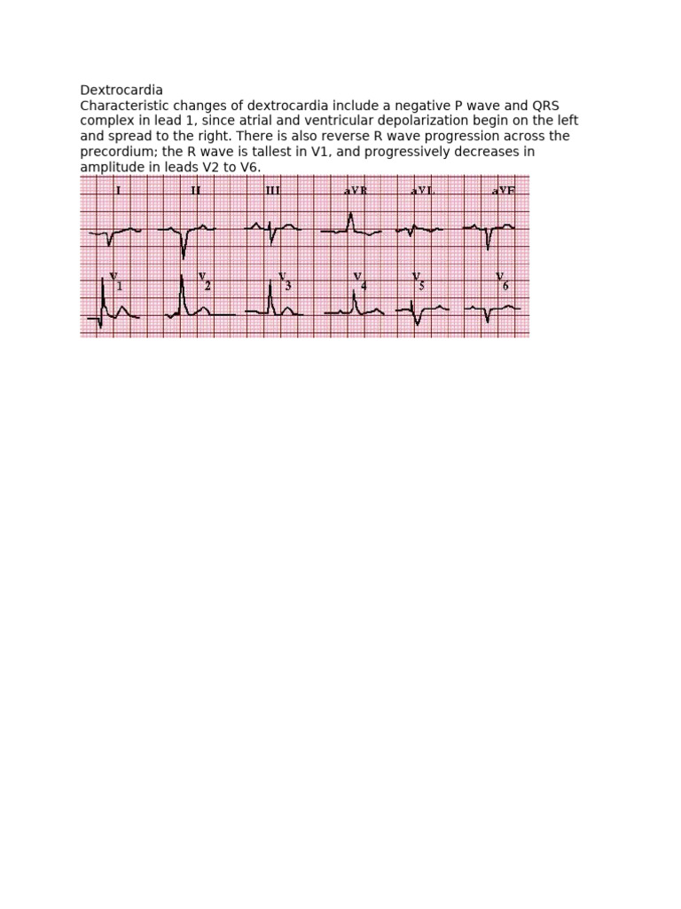 Dextrocardia ECG | PDF