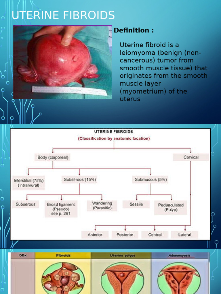 Uterine Fibroids | PDF | Menstruation | Uterus