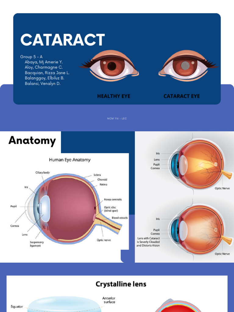 Cataract | PDF | Cataract | Human Eye