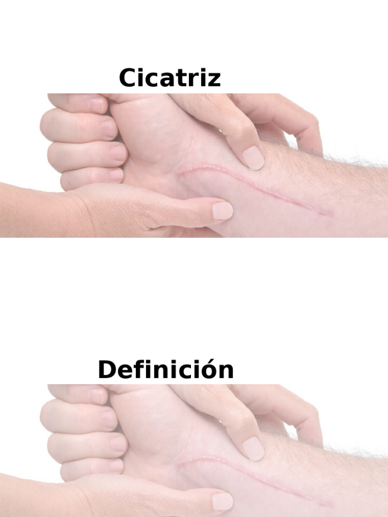 Cicatrización | PDF | Cicatrización de la herida | Cicatriz