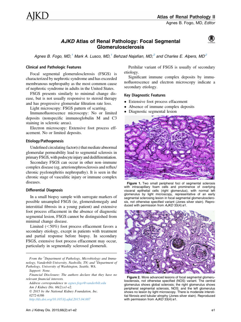 AJKD Atlas of Renal Pathology Focal Segmental Glomerulosclerosis | PDF ...