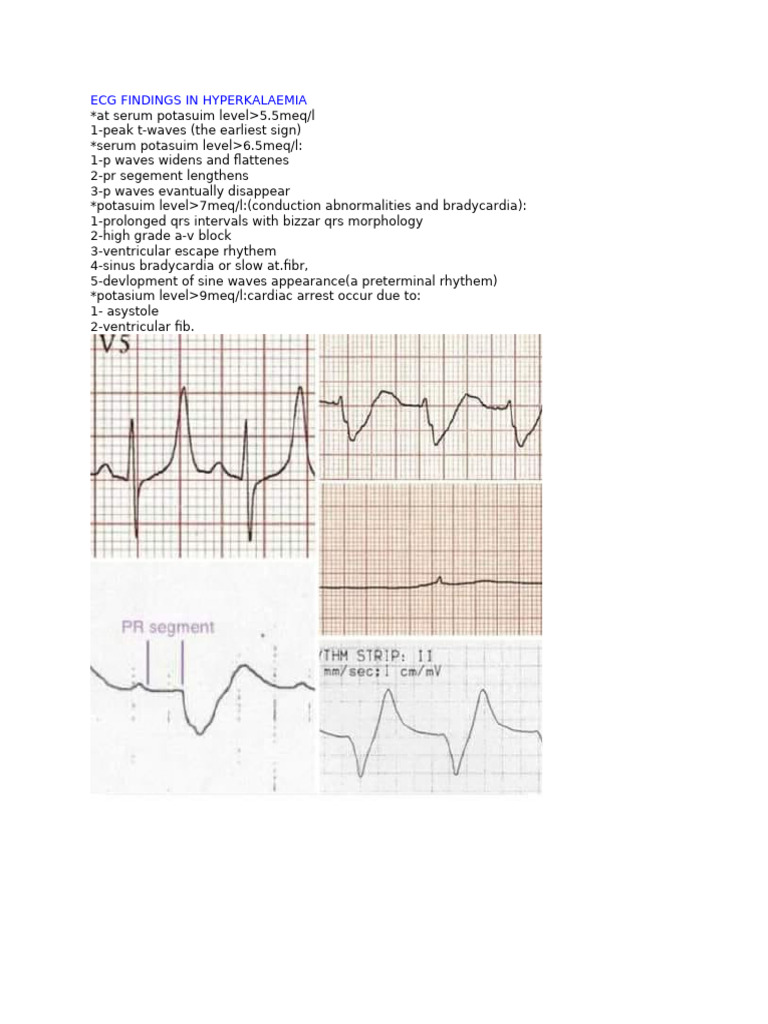 Ecg Findings in Hyperkalaemia | PDF