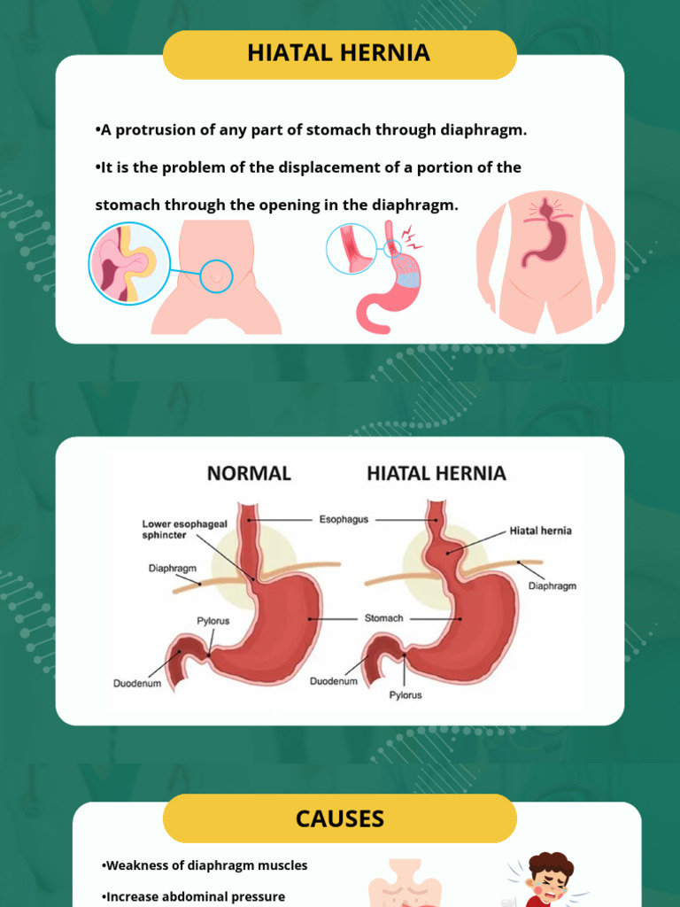 HIATAL HERNIA | PDF