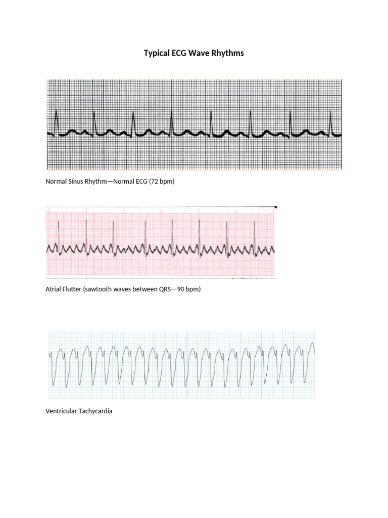 Typical ECG Wave Rhythms | PDF
