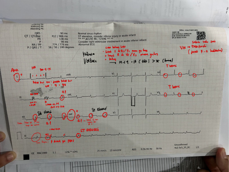Ekg Stemi Inferior | PDF