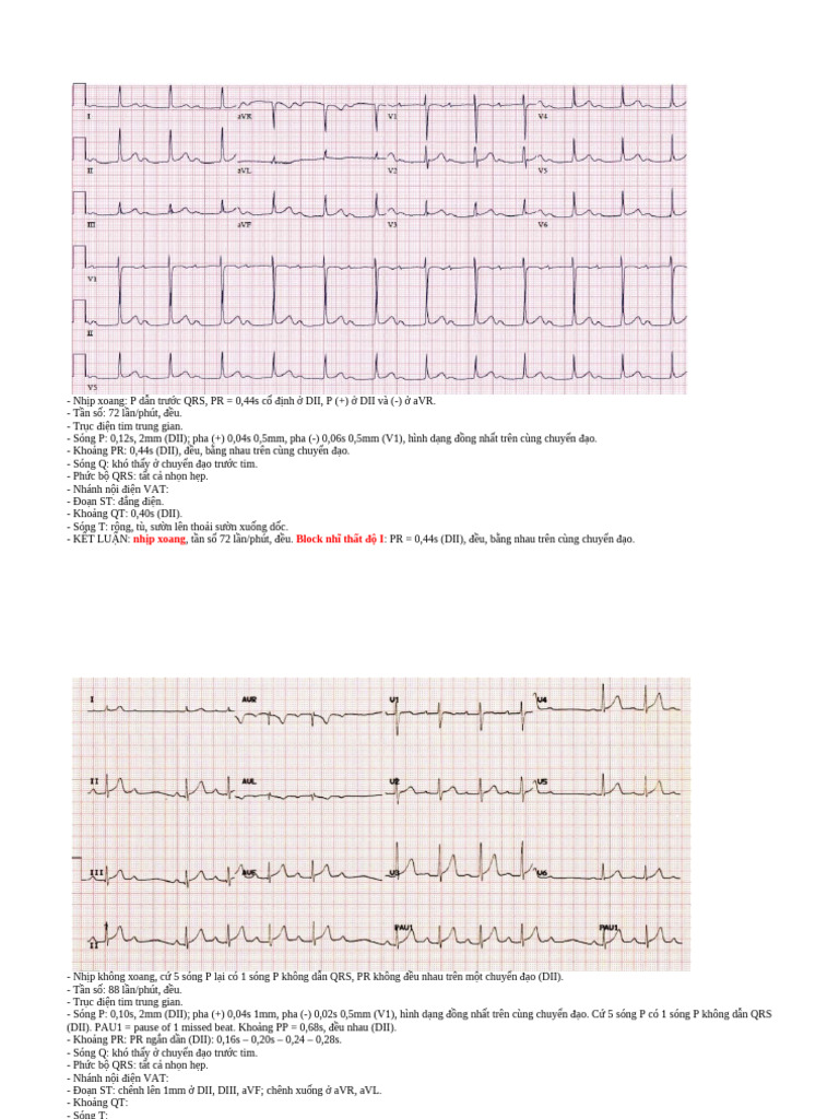BÀI TẬP ECG 2 | PDF