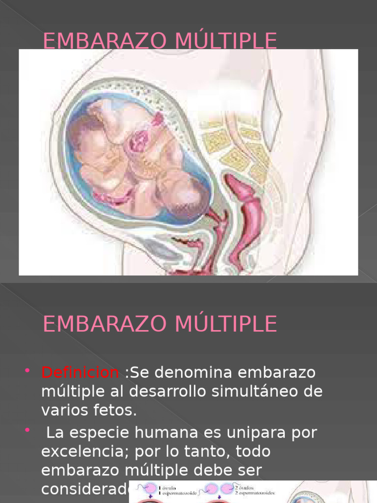 Embarazo Multiple | PDF | Gemelo | Nacimientos Múltiples