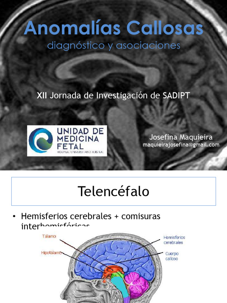 Anomalías del Cuerpo Calloso en Neonatos | PDF | Medicina CLINICA ...