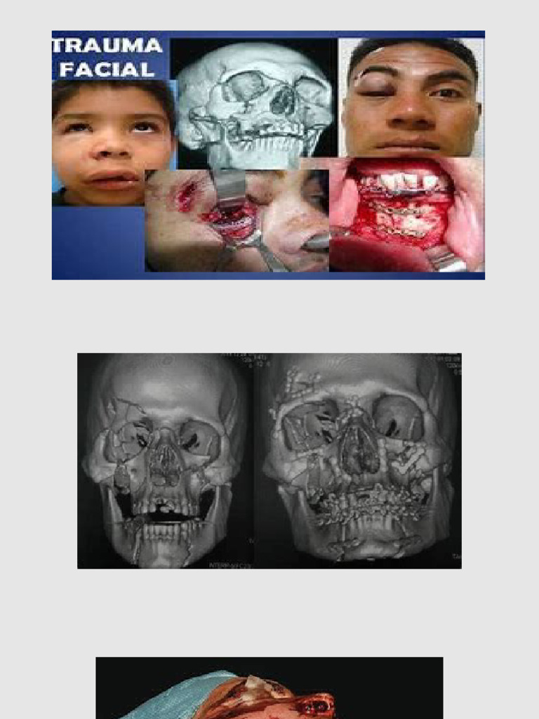 Trauma Facial | PDF