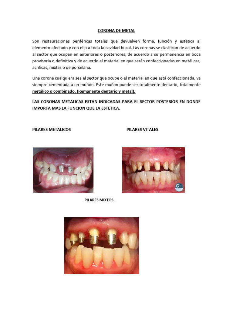 Guía Completa sobre Coronas Metálicas Dentales | PDF | Silicona | Color
