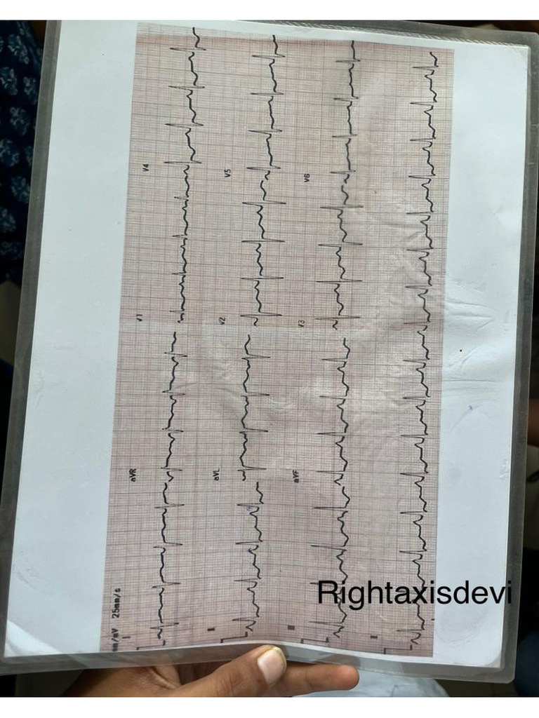 ECG & X-ray | PDF
