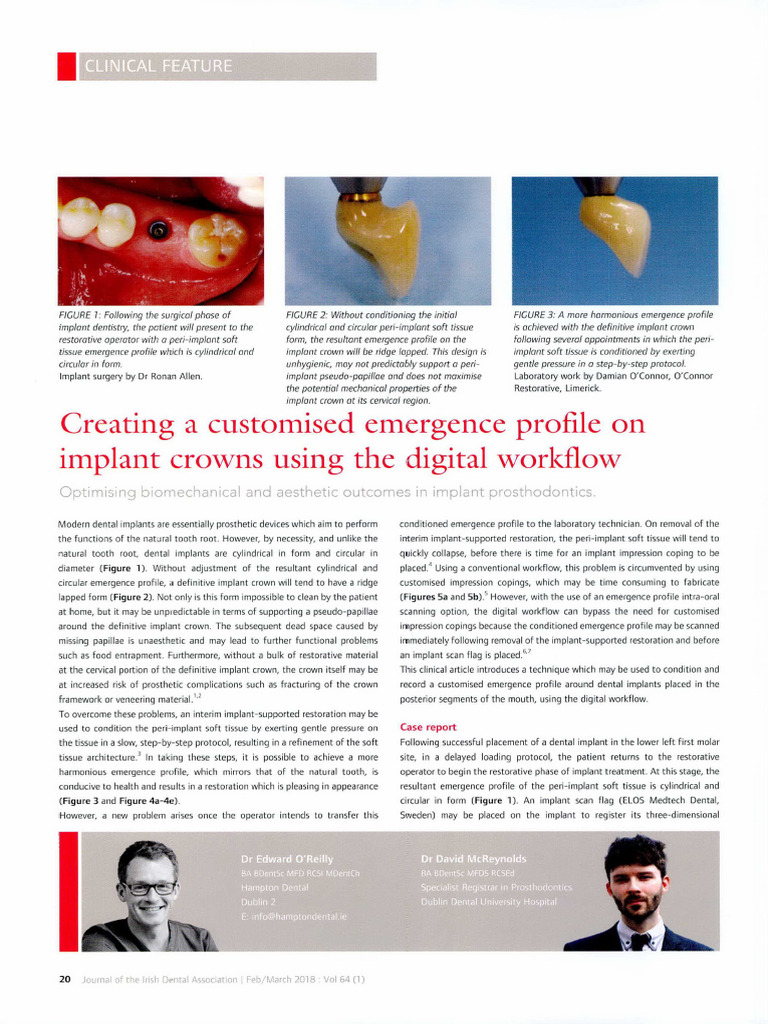 Creating a customised emergence profile on implant crowns using the ...
