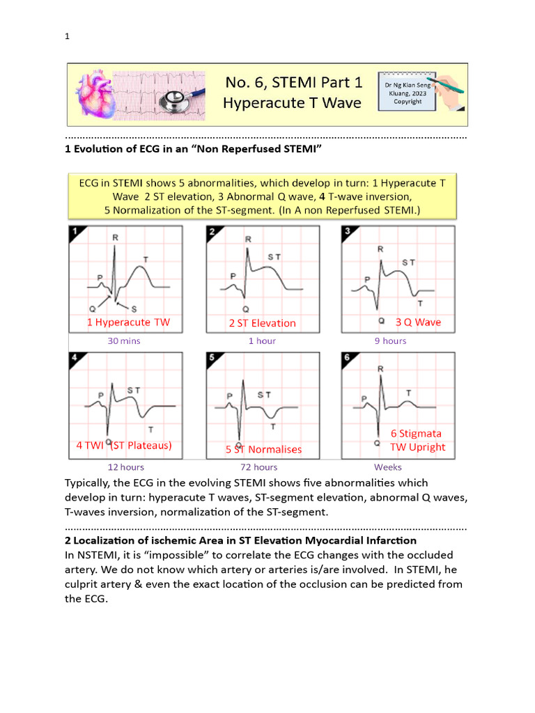 6A STEMI 1, Hyperacute TW | PDF | Myocardial Infarction | Electrocardiography