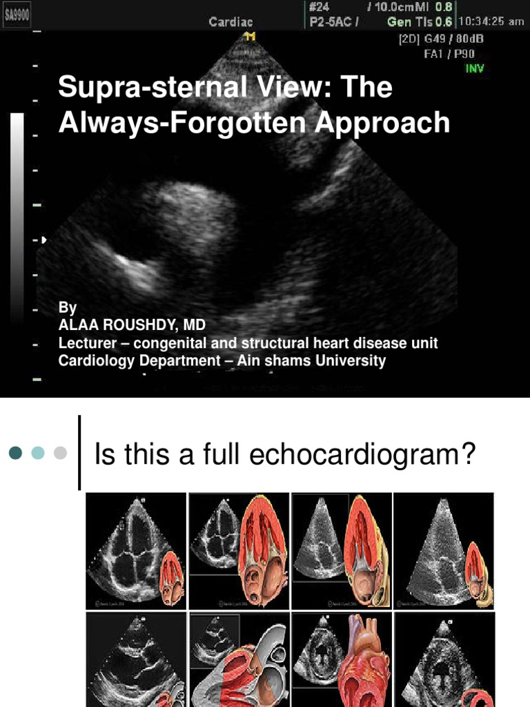 Supra-Sternal View: The Always-Forgotten Approach | PDF | Wellness