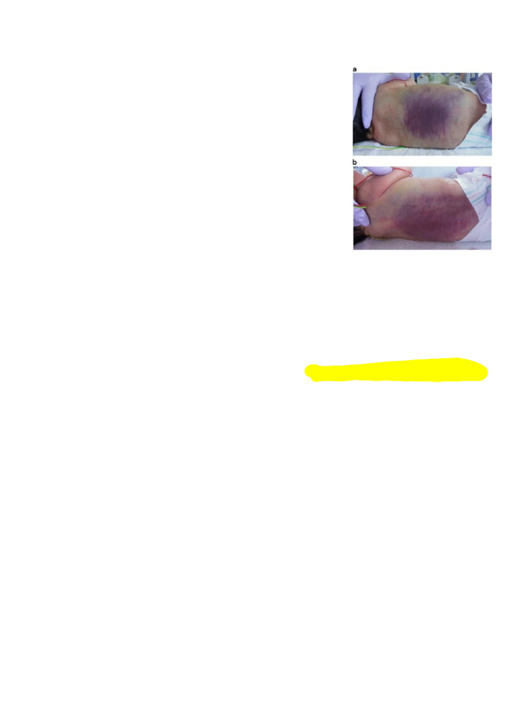 Neonatal Bleeding Disorders Guide | PDF | Coagulation | Bleeding