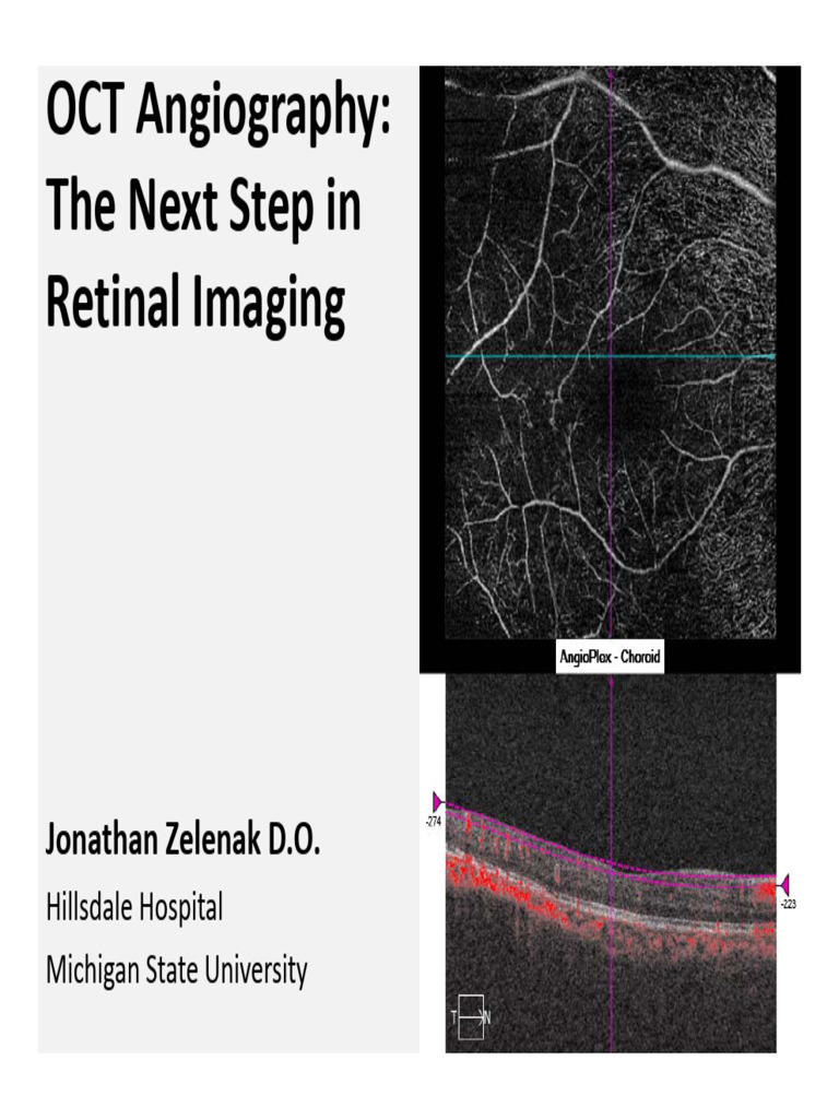 OCT Angiography | PDF | Ophthalmology | Angiography
